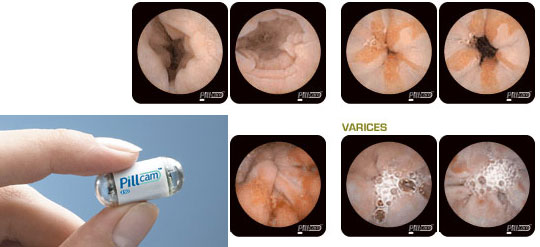 Endoscopia Por Cápsula; Endoscopia Capsular; Endoscopia por ...